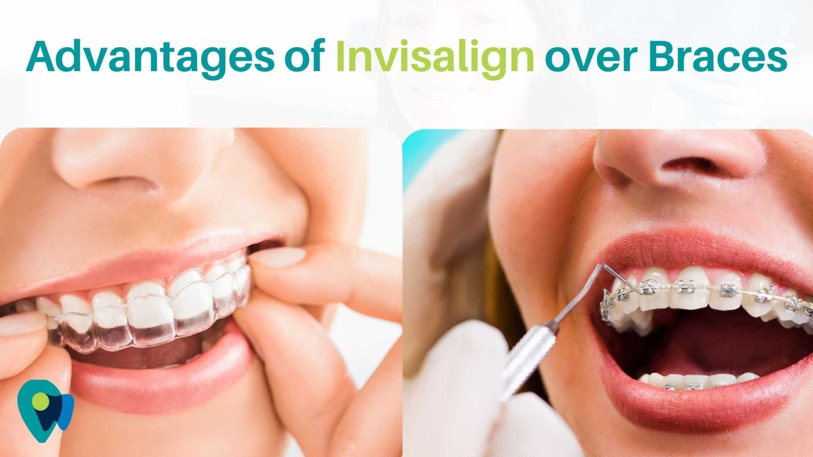 Advantages of Invisalign over Braces |Best Orthodontist in Gurgaon